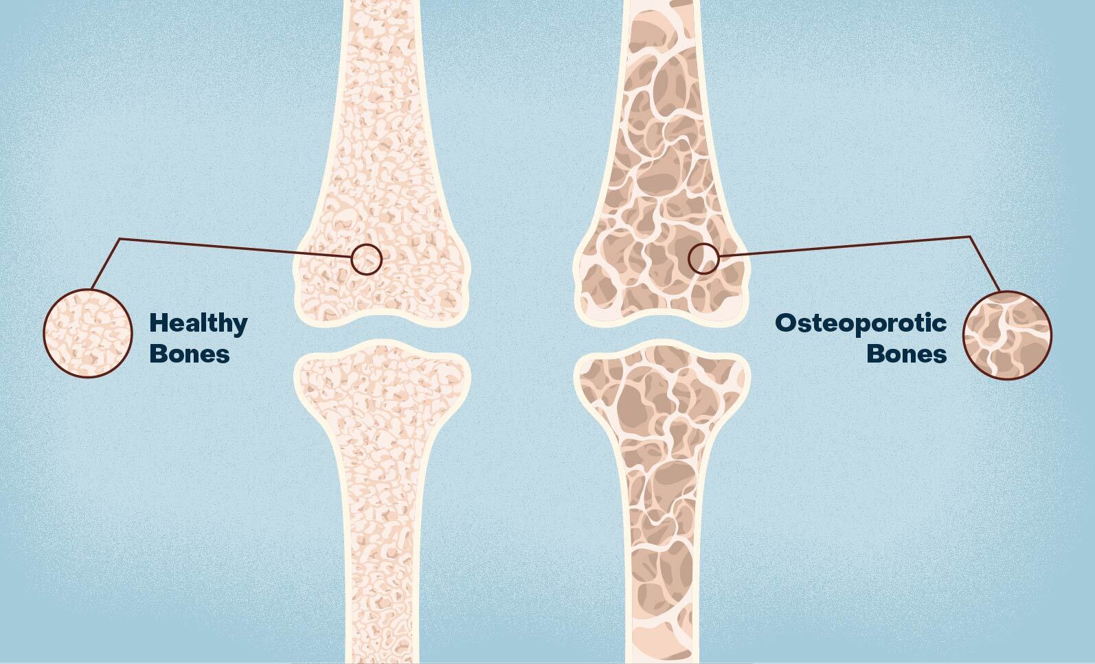 Tips for Preventing Osteoporosis - Renaissance Health Centre